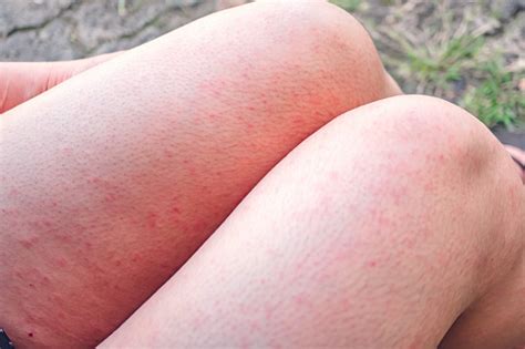 Enfermedad De La Piel En El Cuerpo Enfermedad Viral De La Piel Erupción