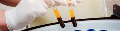 Prp Injections The Healing Joint