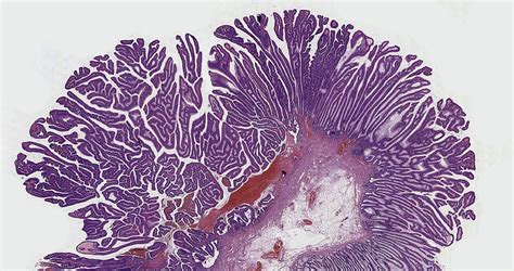 Pathology Outlines Tubulovillous Villous Adenoma