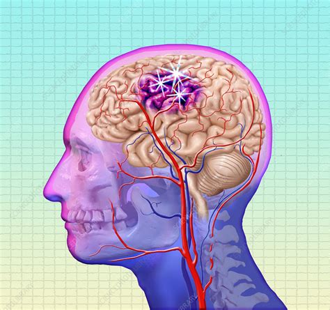 Stroke Illustration Stock Image C027 6635 Science Photo Library