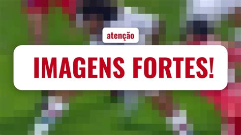 VÍdeo Imagens Fortes Marcelo Do Fluminense Quebra Sem Querer A