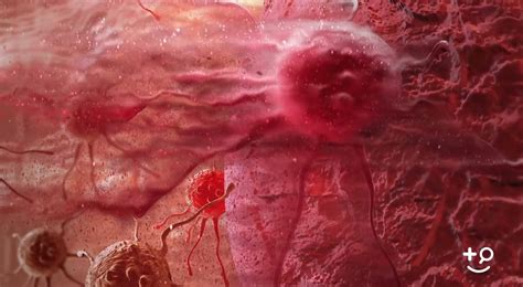 Lung Cancer Types Doctorpedia Doctor Reviewed Video