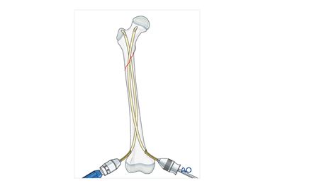 Titanium Elastic Nail System All About Pptx