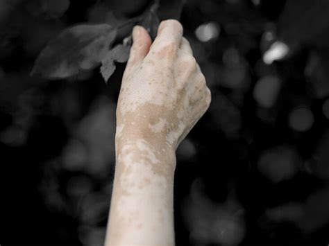 Hyperpigmentation Arms