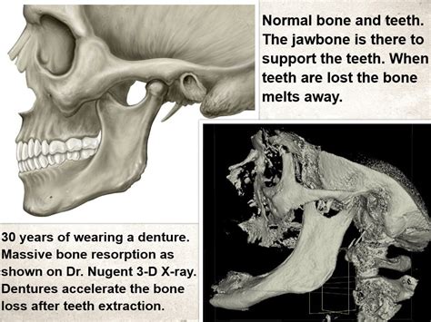 How Dental Implants Prevent Bone Loss Pasadena TX Implant Dentist