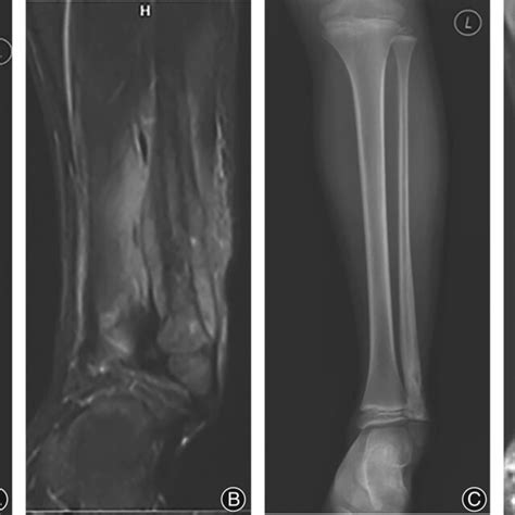 Preoperative Radiographic Examination Of Patient A X‐ray Before