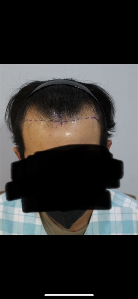 약혐 모발이식 병원에서 수술전 수술후 사진 받았음 패션 에펨코리아