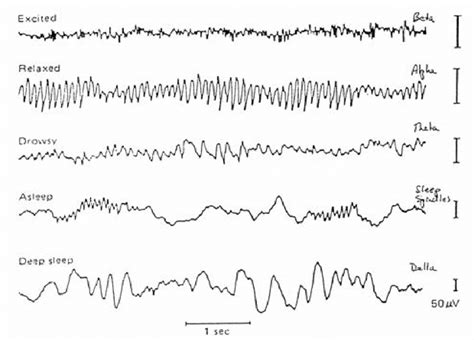 3 Types Of Eeg Signals Download Scientific Diagram