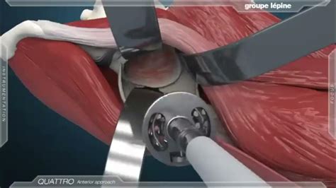 Prothèse Totale De Hanche Pth Chirurgie Arthrose Voie Antérieure Mini