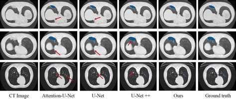 Automatic COVID19 CT Segmentation Using UNet Integrated Spatial And