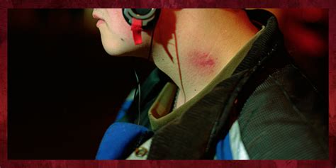 Teen Dies After Receiving A Hickey From His Girlfriend
