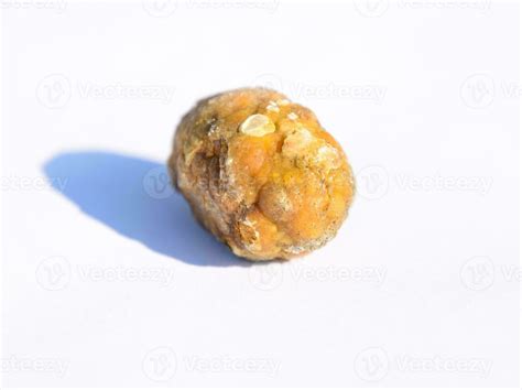 Stone Of Gallbladder The Result Of Gallstones A Calculus Of