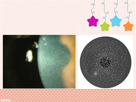 Diffuse Lamellar Keratitis DLK PPT Eye And Vision Conditions Diseases And Conditions