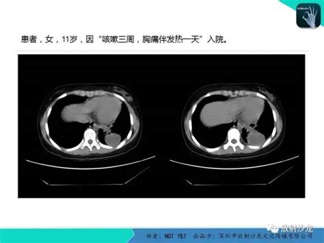 【病例】肺脓肿1例ct影像诊断与鉴别 影像ppt