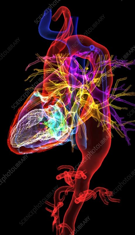 Aortic Aneurysm Ct Scan Stock Image C0593694 Science Photo Library