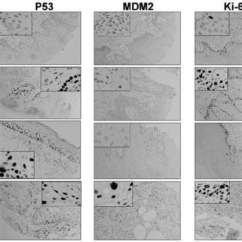 Expression Of P16 Prb Senescence Pathway Markers Cyclin D1 And Rb And