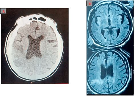 B Mri Transversale Plane Revealing Right Frontal Temporal And Parietal Download Scientific
