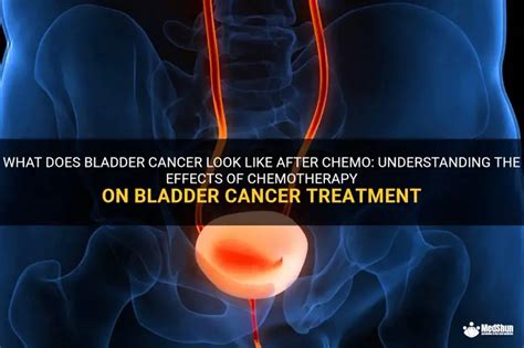 What Does Bladder Cancer Look Like After Chemo Understanding The