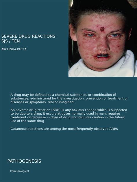 Sjs Ten Pdf Immunology Diseases And Disorders