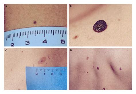 Dysplastic Nevus Icd 10