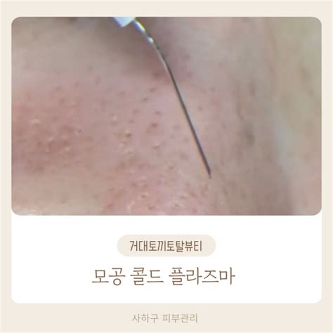 사하구피부관리 거대토끼토탈뷰티에서 모공 콜드 플라즈마 후기 네이버 블로그