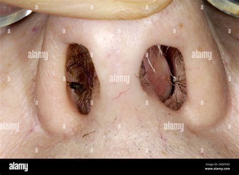 Septum Anormal Close Up Du Nez D Un Homme De Ans Avec Une D Viation