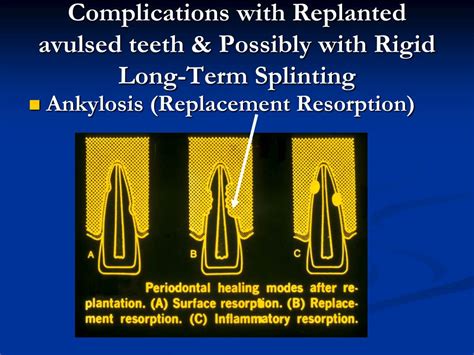 PPT Lecture 9 Traumatic Injuries Cracked Teeth And Vertical Root