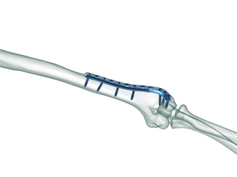 TRUE LOCK Distal Humerus Lateral Anatomic Plate CYGAPORT LLC