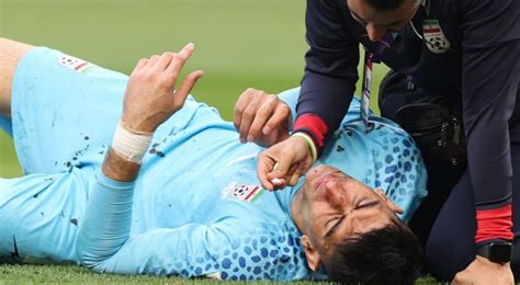 Goleiro do Irã sai sangrando após se chocar colega de time durante