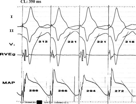 Monophasic Action Potential Map Recorded From The Right Ventricle Download Scientific Diagram