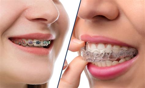 Invisalign Vs Braces Pros And Cons Center For Restorative