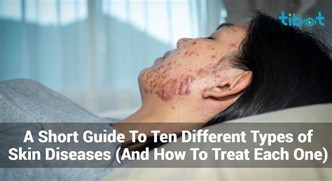 Unveiling Ten Common Skin Diseases A Brief Guide By Eczemaless
