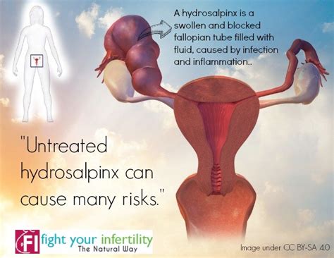 Hydrosalpinx In Fallopian Tubes And Seven Treatment Options