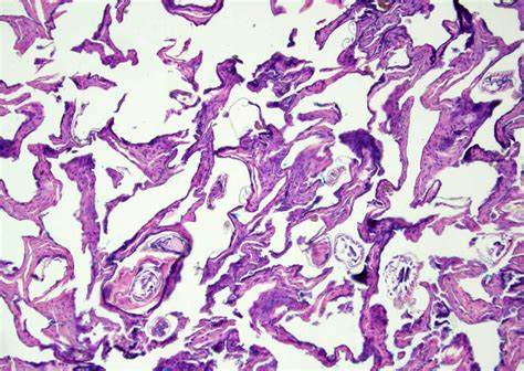 Pathology Outlines Scabies Mite