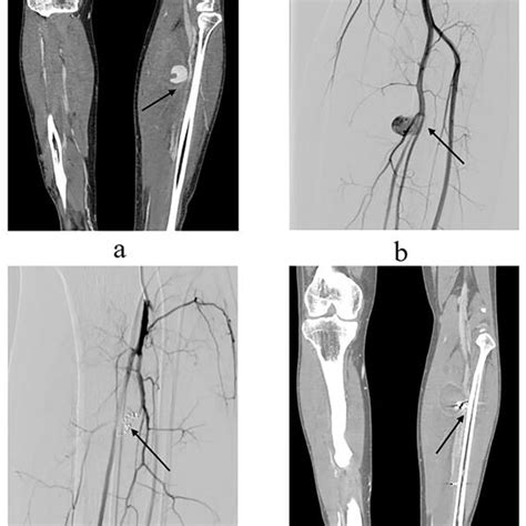 A B Computed Tomography Angiography And Digital Subtraction Download Scientific Diagram