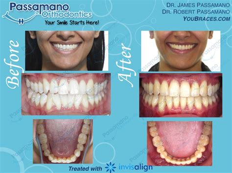 Lower Crowding Fixed With Ipr And Permanent Retainer A Passamano