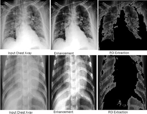 Illustrations Of Roi Extraction Of Raw X Ray Images Download