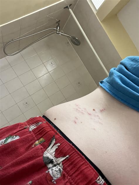 Does This Look Like Shingles To You Feels Like A Bug Bite That You