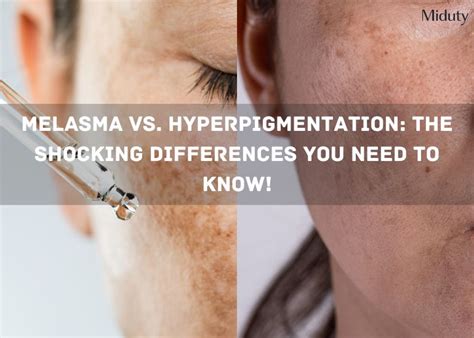 Hyperpigmentation Vs Melasma Key Differences And Treatments Miduty