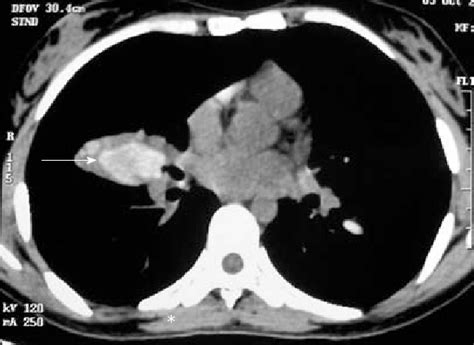 High Resolution Computed Tomography Ct Of The Chest Showing High