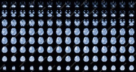 Ressonância Magnética Cerebral Cortes Axiais Para Avaliar Tumor