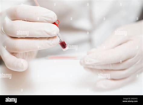 Laboratory Assistant Holds Test Tube Close Up For Gynecological And Cytological Analysis Woman