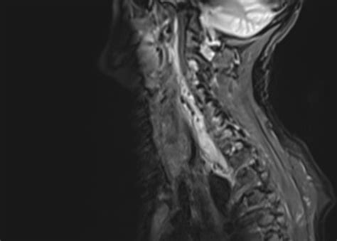 Prevertebral Neck Abscess With Salmonella Sandiego A Case Presentation