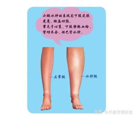 腿肿是身体健康的吹哨人腿肿了都是血栓惹的祸吗 知乎