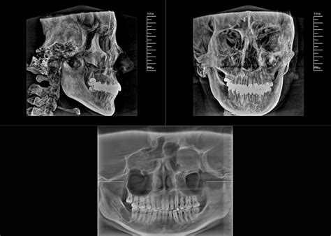 Cbct