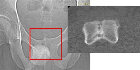 What Is Osteitis Pubis Can It Be Fixed Regenexx