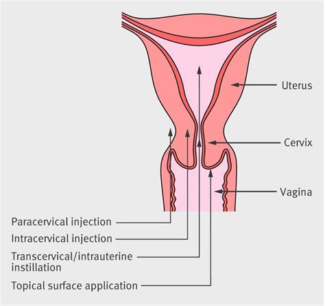 Local Anaesthesia For Pain Control During Outpatient Hysteroscopy