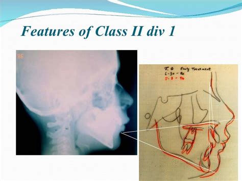 Management Of Class Ii Division 1 Malocclusion