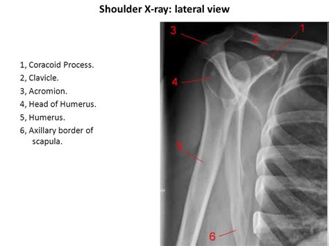 Coracoid Process X Ray
