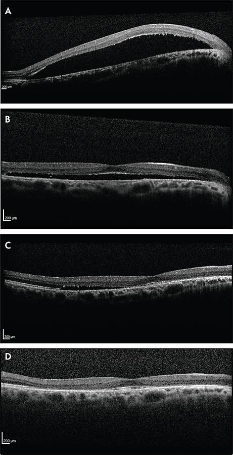 Treatment Of Optic Disk Pit Maculopathy Retinal Physician